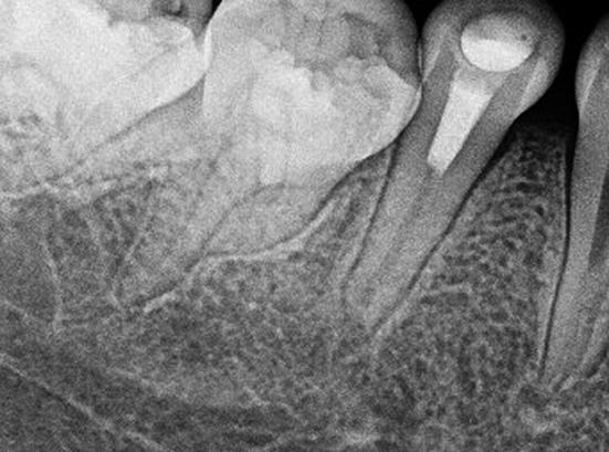 Revista Canal Abierto - Pulpar regenerative procedures in cases of pulp ...